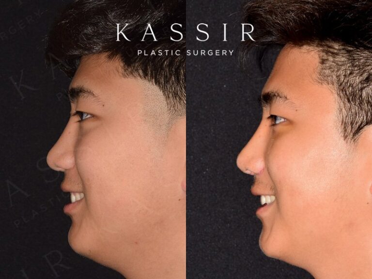 Real Patient Case: 4320 | Kassir Plastic Surgery | New York City | New ...